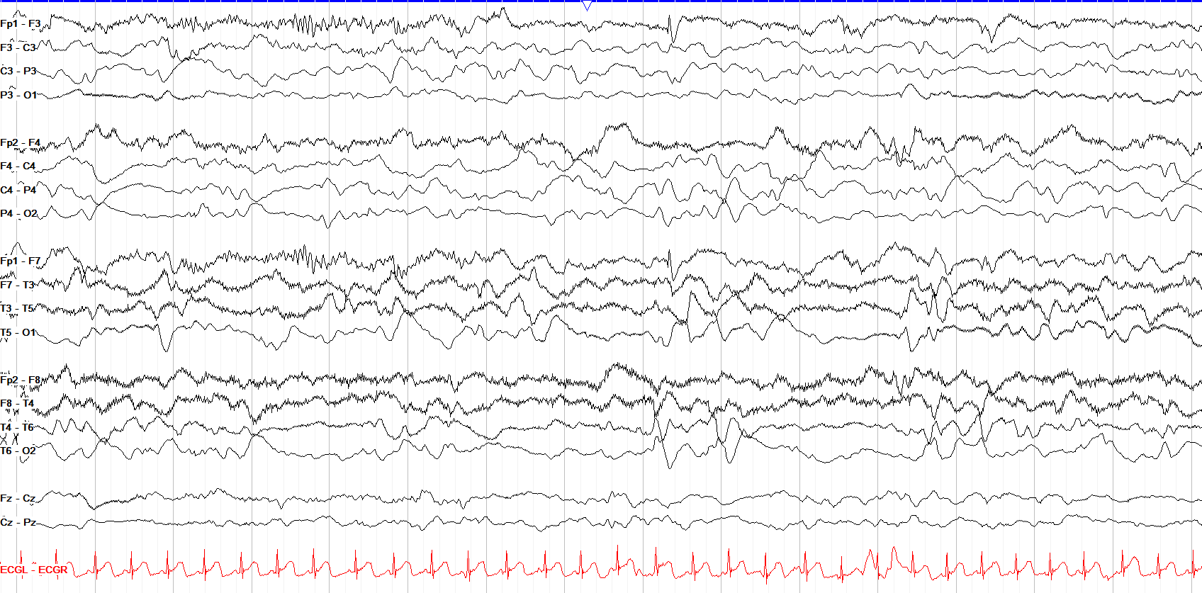Epileptiform Activity on EEG